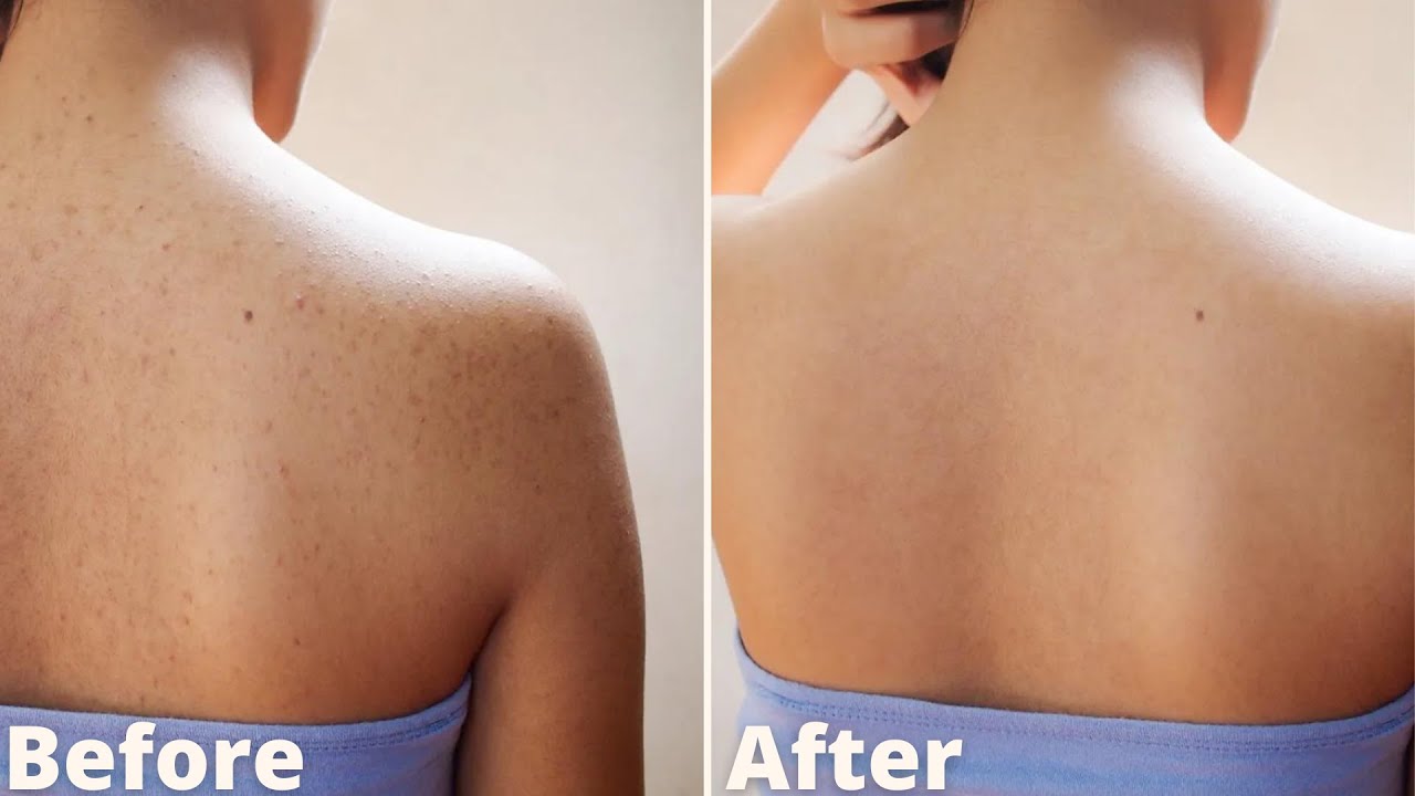 Get rid of body & back acne soon | 1% Salicylic Acid Body Wash Review ...