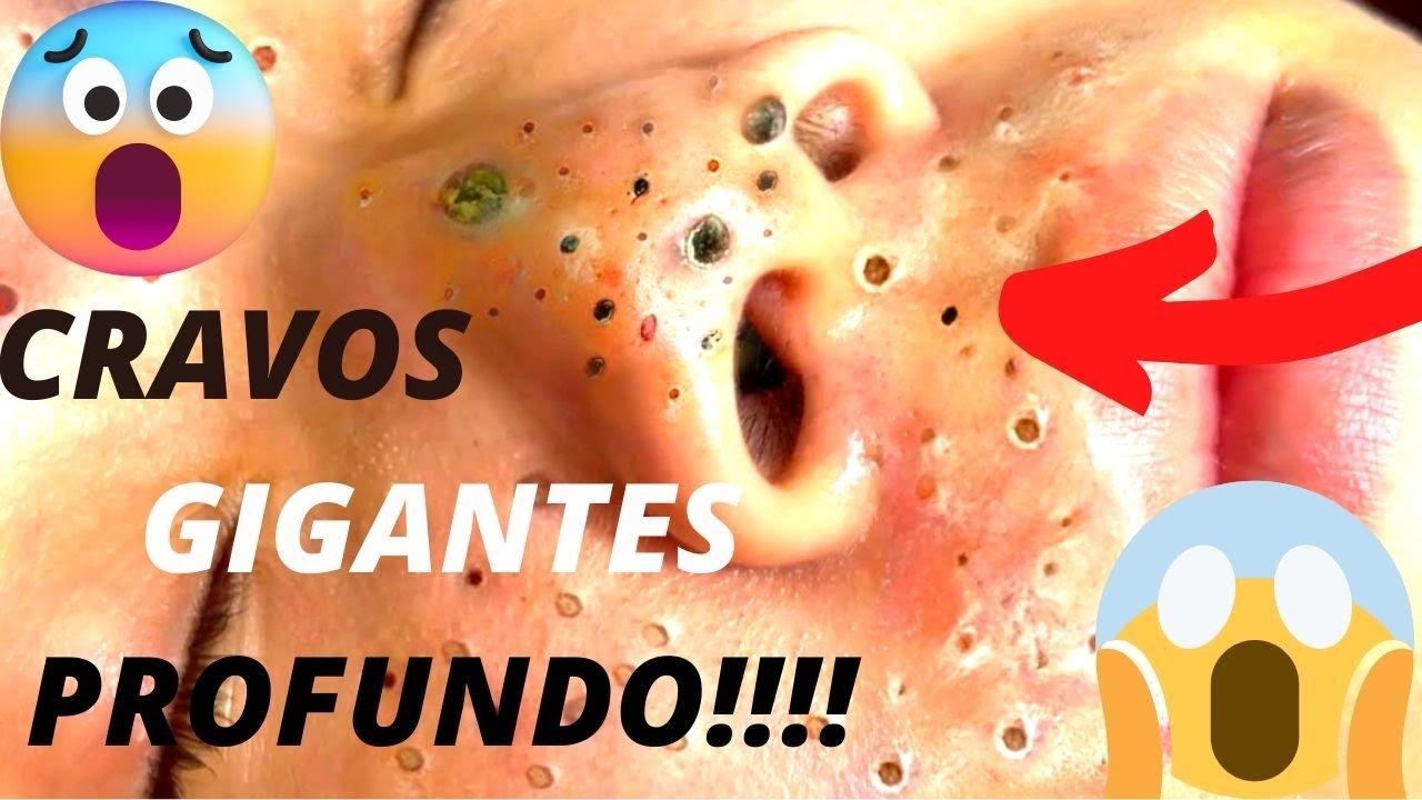 Espremendo Cravos Gigantes e Profundo No Nariz e Rosto #Satisfatorio # ...