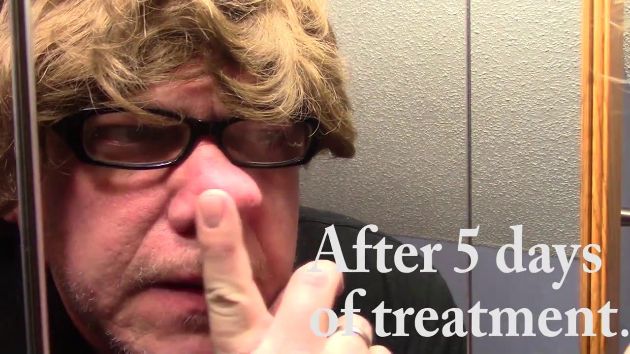 My Last 14 Days of Using Zyclara for Actinic Keratosis on My Nose - YouTube