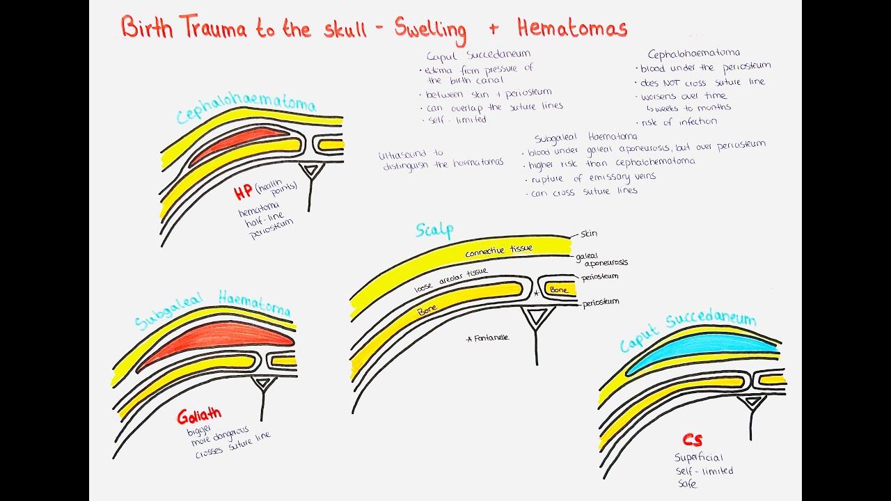 Caput Succedaneum, Cephalohematoma, Subgaleal Hemorrhage - YouTube