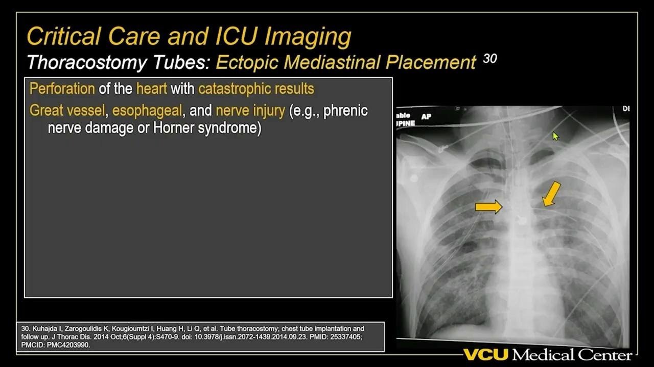 Ectopic Mediastinal Placement - YouTube