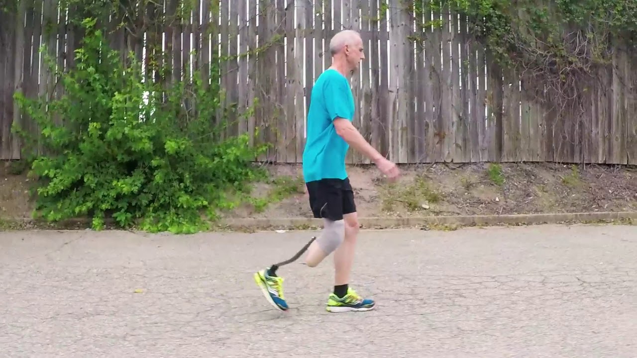 Case Study 4 - Walking with Cheetah® Xplore foot (Lateral) - YouTube