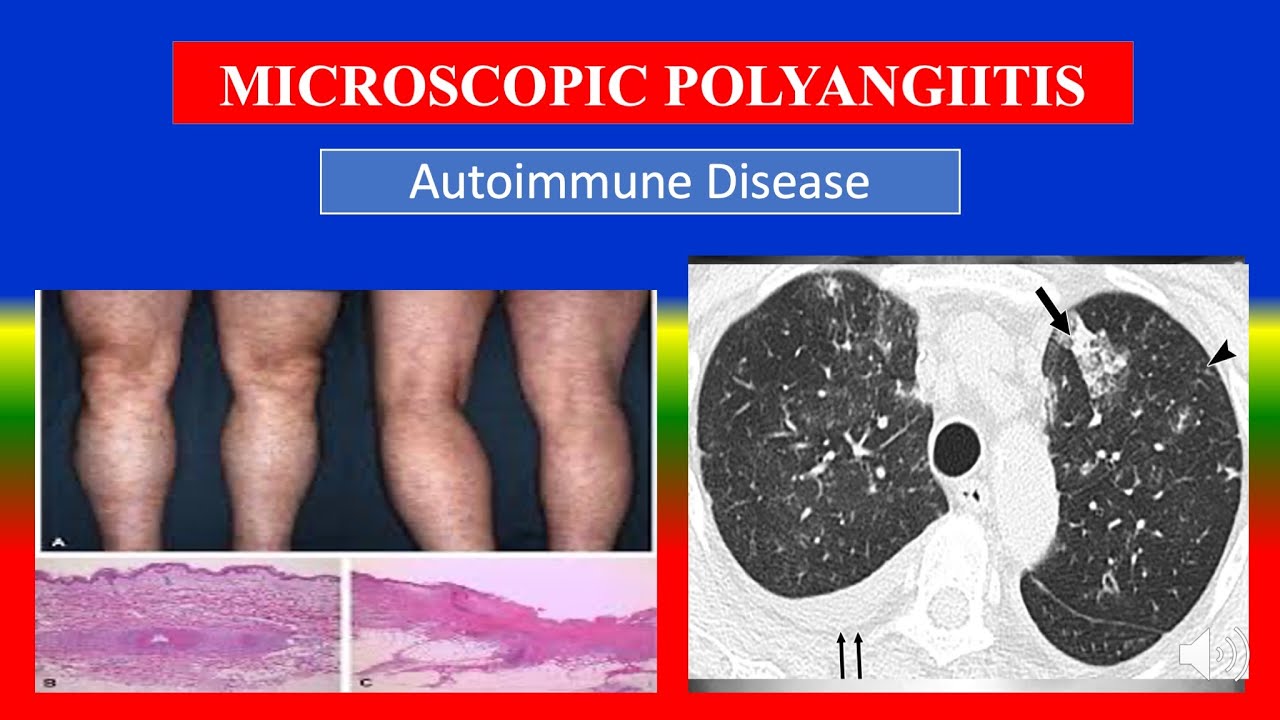 MICROSCOPIC POLYANGIITIS - Definition, types, causes, pathophysiology ...