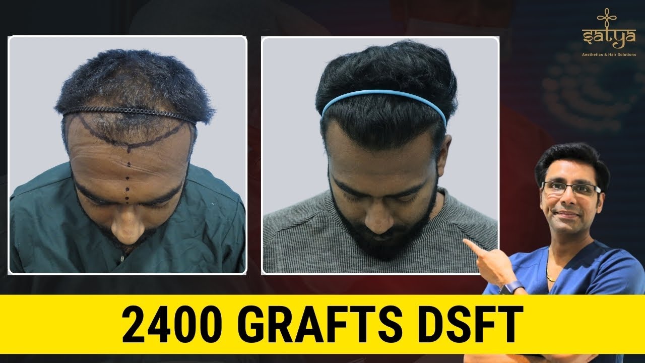 2400 Grafts DSFT | 2400 grafts hair transplant | DSFT | DSFT hair ...