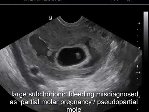 case 433 large subchorionic bleeding misdiagnosed as partial molar ...