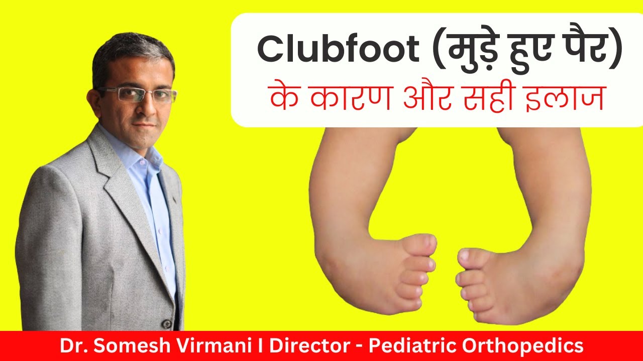 Club foot क्यों होता है? I Club foot का सही इलाज क्या है ? / Dr Somesh ...