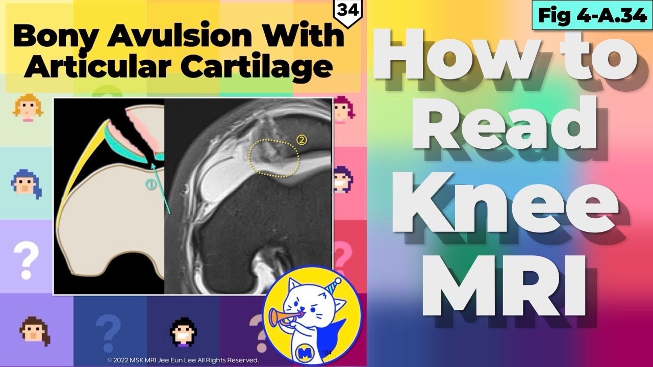 (Fig 4-A.34) Type P2/ Bony Avulsion with Articular Cartilage from ...