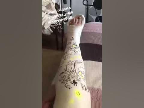Нога в гипсе_7 - YouTube