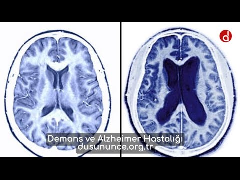 Demans ve Alzheimer Hastalığı