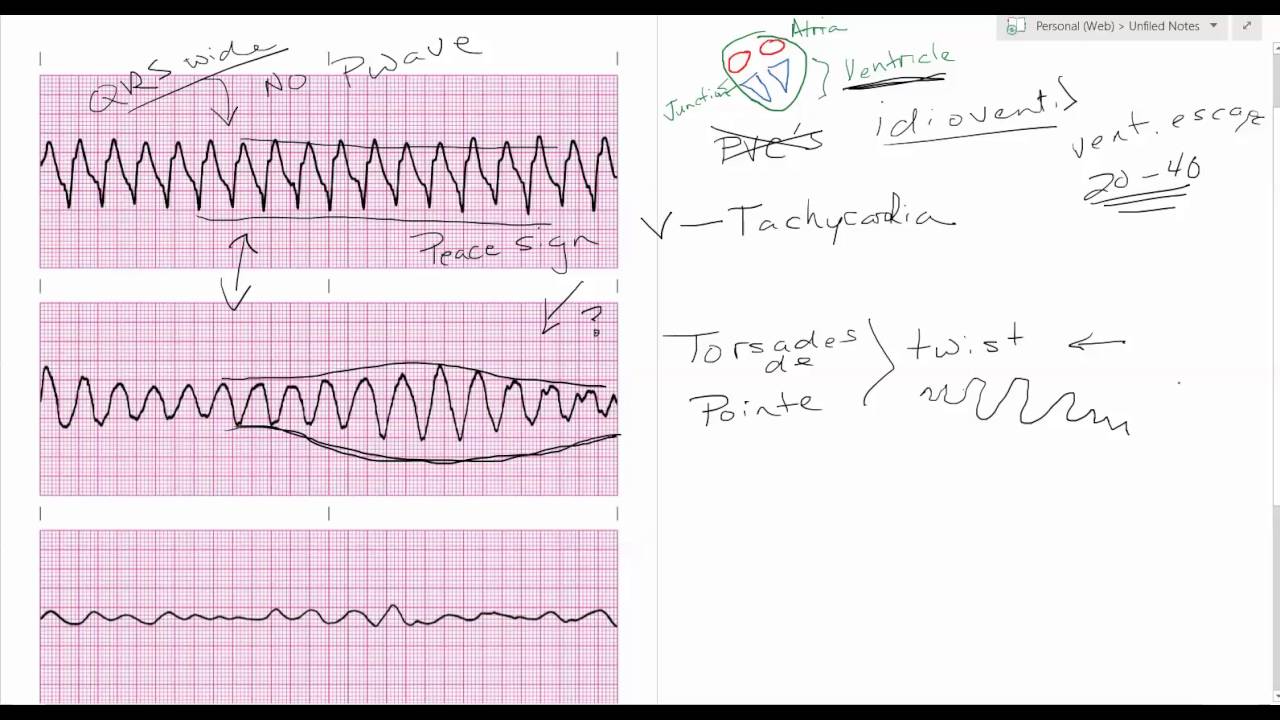 Comparing ventricular rhythms - YouTube