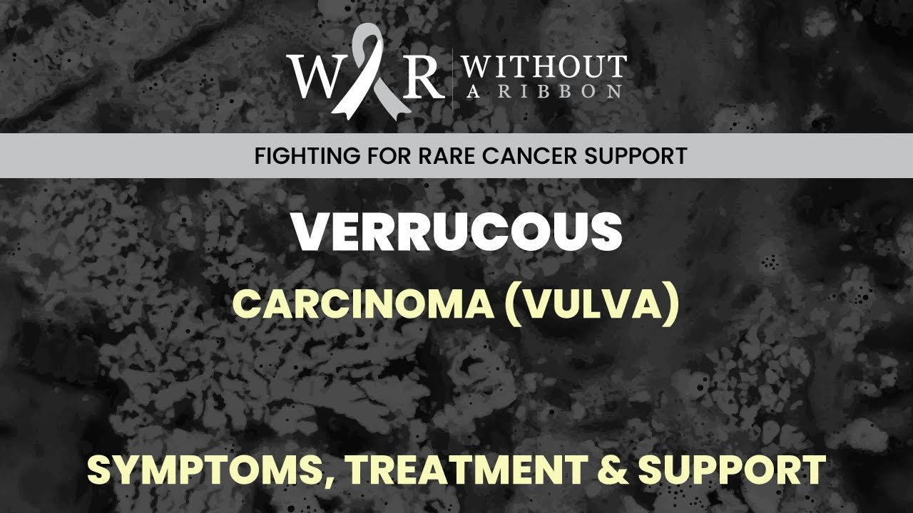 VERRUCOUS CARCINOMA (VULVA) – SYMPTOMS, TREATMENT & SUPPORT - YouTube