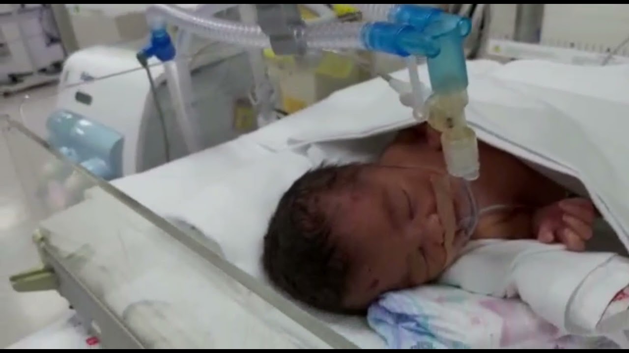 Case 640 Is it my baby ready for extubation? how can I know? Good ...