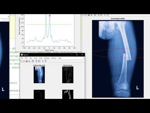Matlab Kullanılarak Kemiklerde Kırık Tespitti
