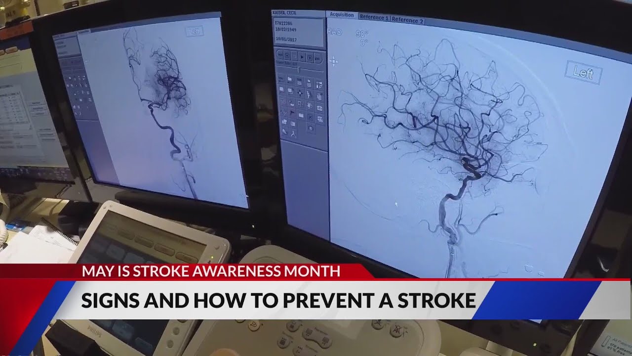 Signs and how to prevent a stroke - YouTube
