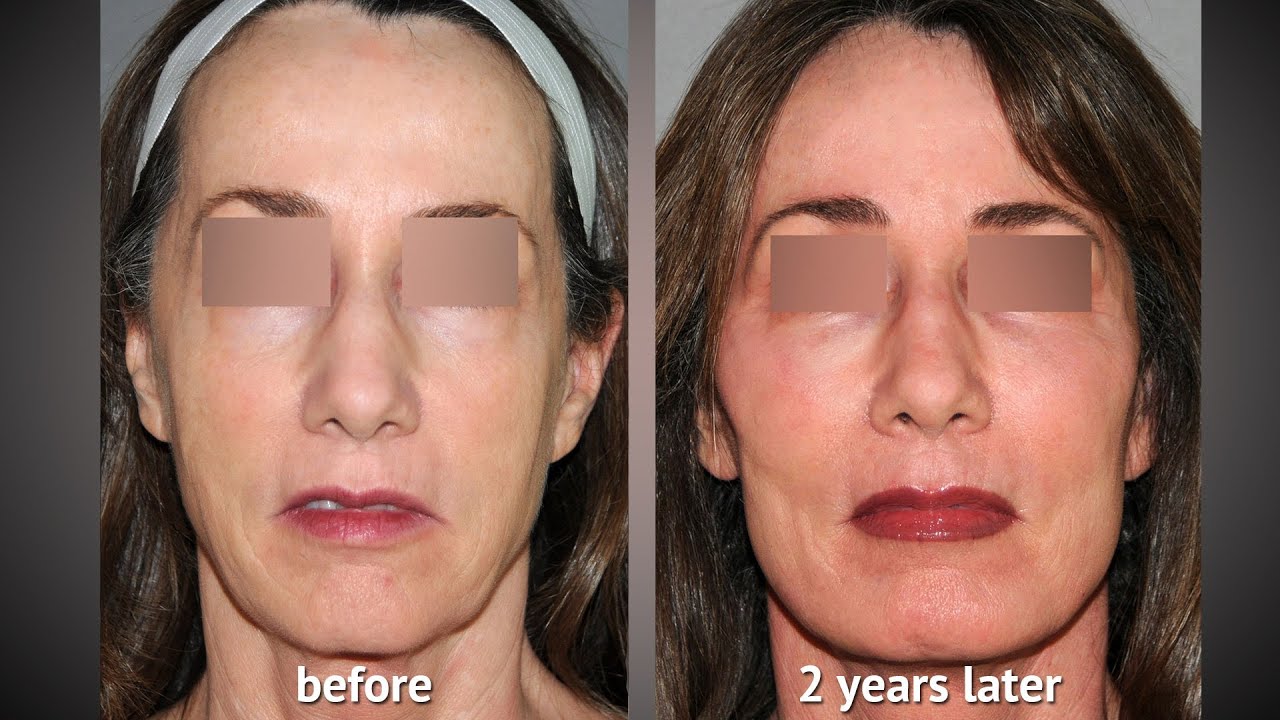 Y LIFT ® 2012 - Blythe | Instant, Non Surgical Facelift - YouTube