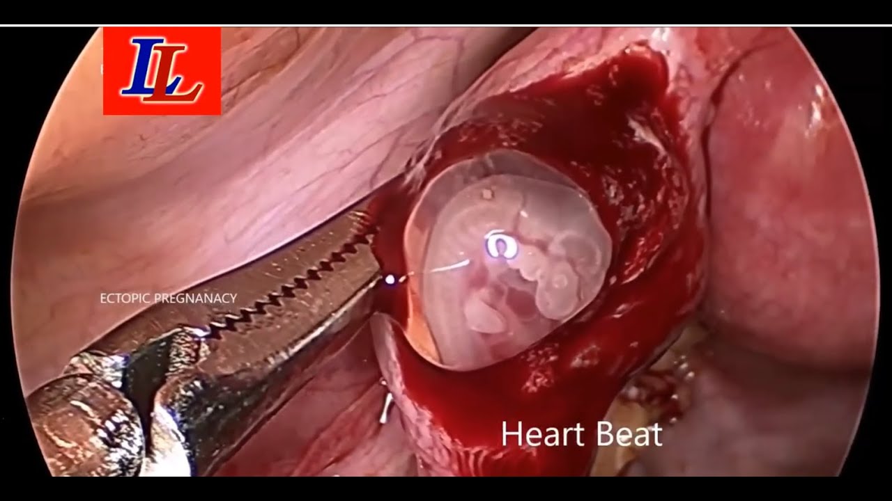 Ectopic Surgery with tube preserved - YouTube