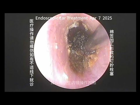 How to use an otoscope to clear cerumen impaction from various causes ...