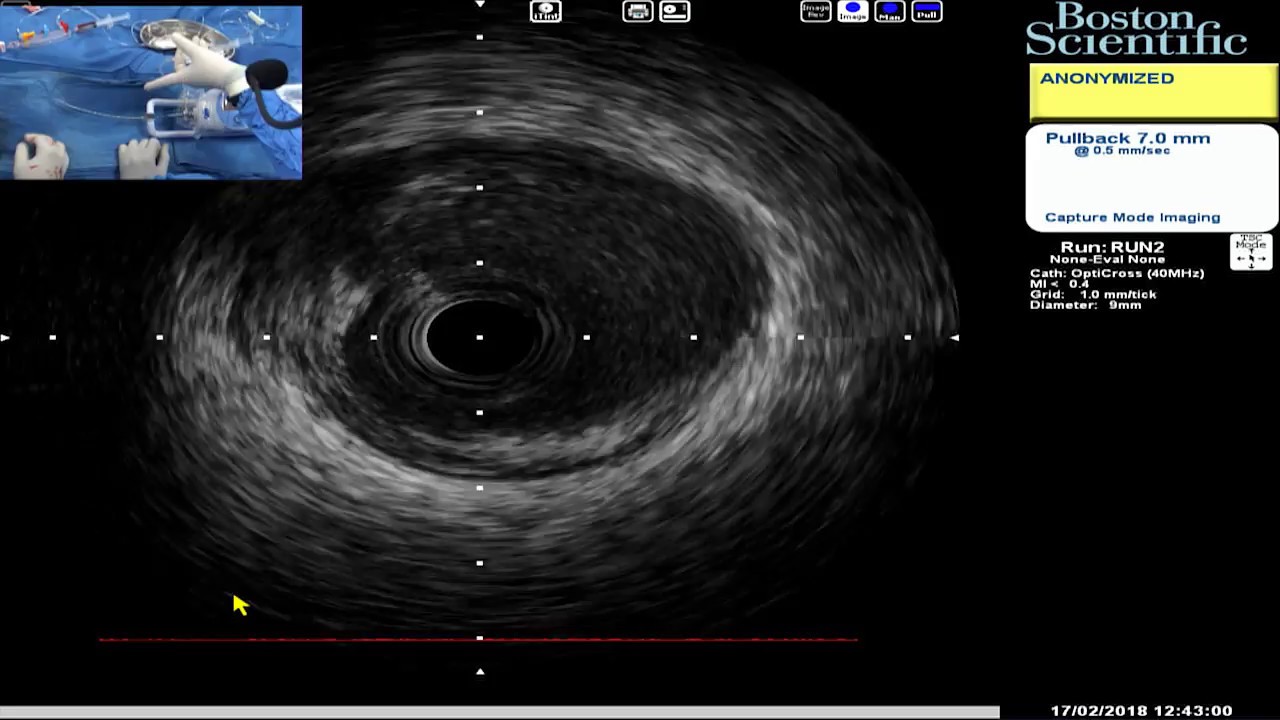 PCI to LCX-OM Bifurcation & LAD Lesions & IVUS evaluation - YouTube