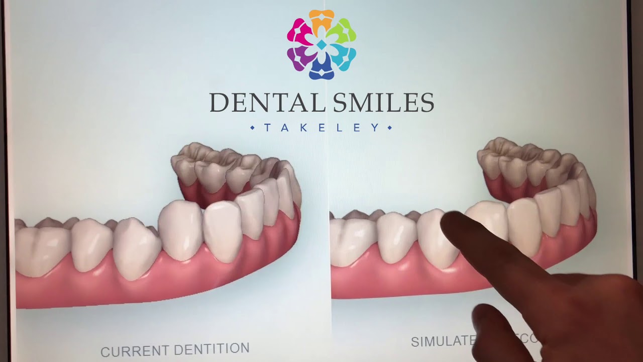 Dental Smiles Invisalign 3D Scan - YouTube