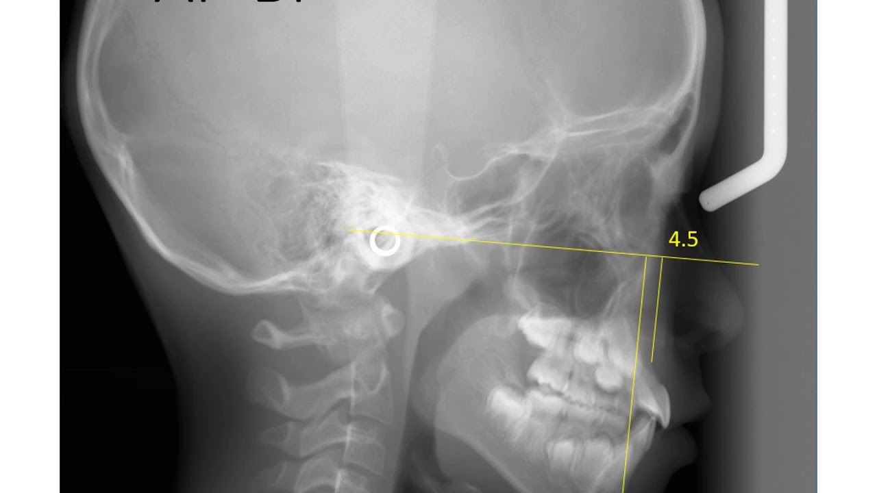 Early orthodontic treatment：A comparison of ANB, Wits, AF BF, APDI ...
