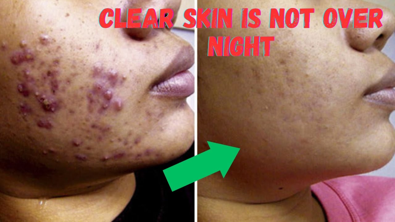 Acne Daily Routine Tips That Works - YouTube
