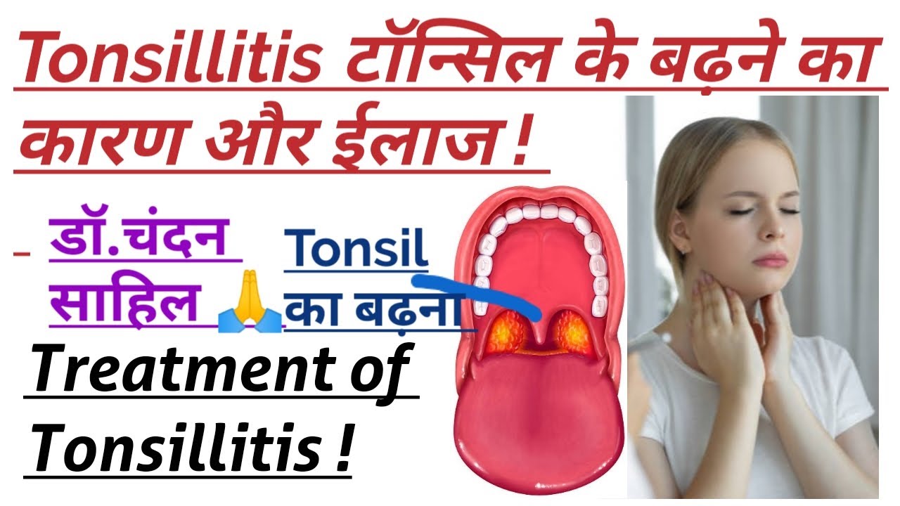 टॉन्सिल के बढ़ने का इलाज ll Tonsillitis treatment ll Tonsil Me Sujan ...