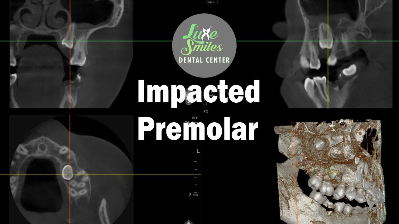 Impacted Upper Premolar Palatal Approach by Dr Louie Panganiban at Luxe ...