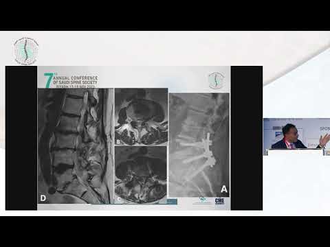 Evolution of Prone Lateral Interbody Fusion by Dr. Muhammad Abd-El-Barr ...