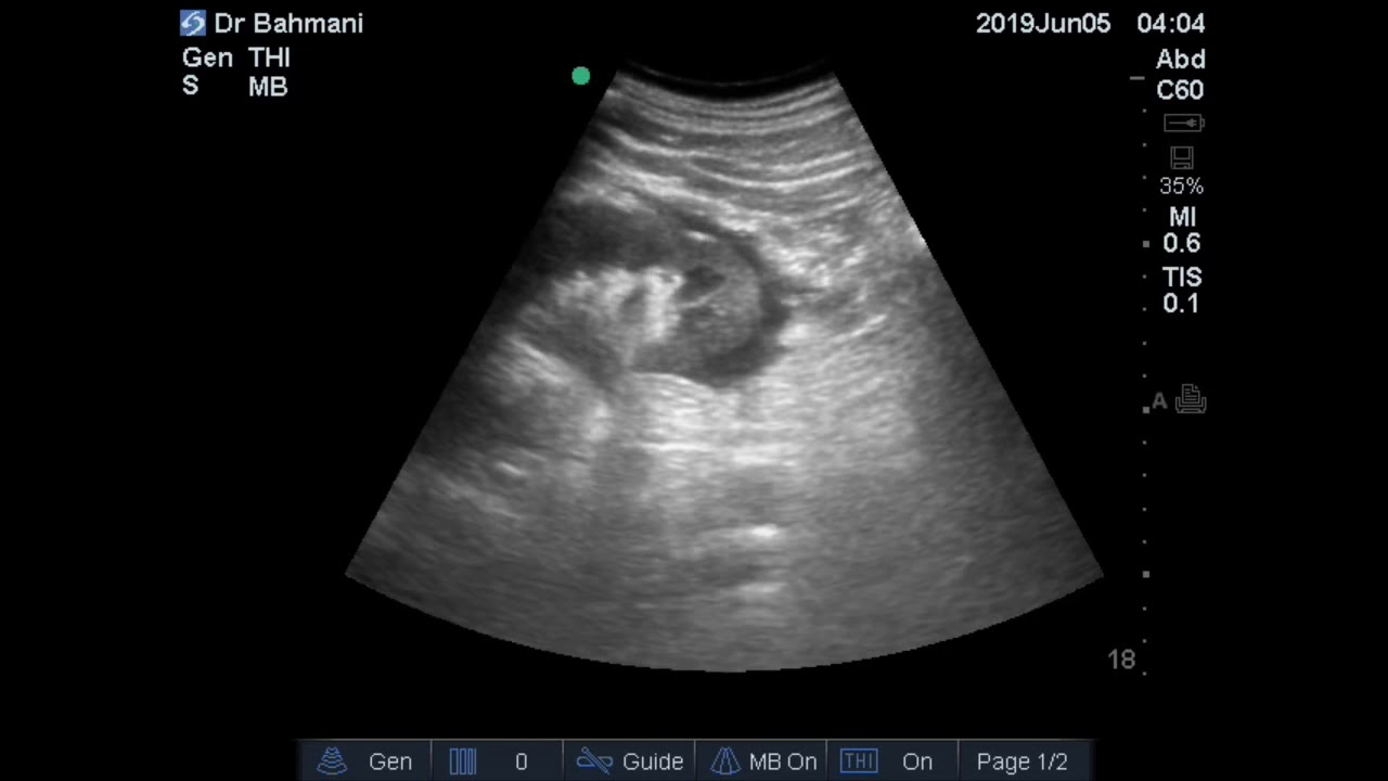 Case 13: Fornix rupture - YouTube
