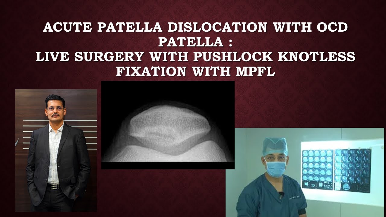 Patella OCD fixation with Pushlock with MPFL live surgery . Dr ...