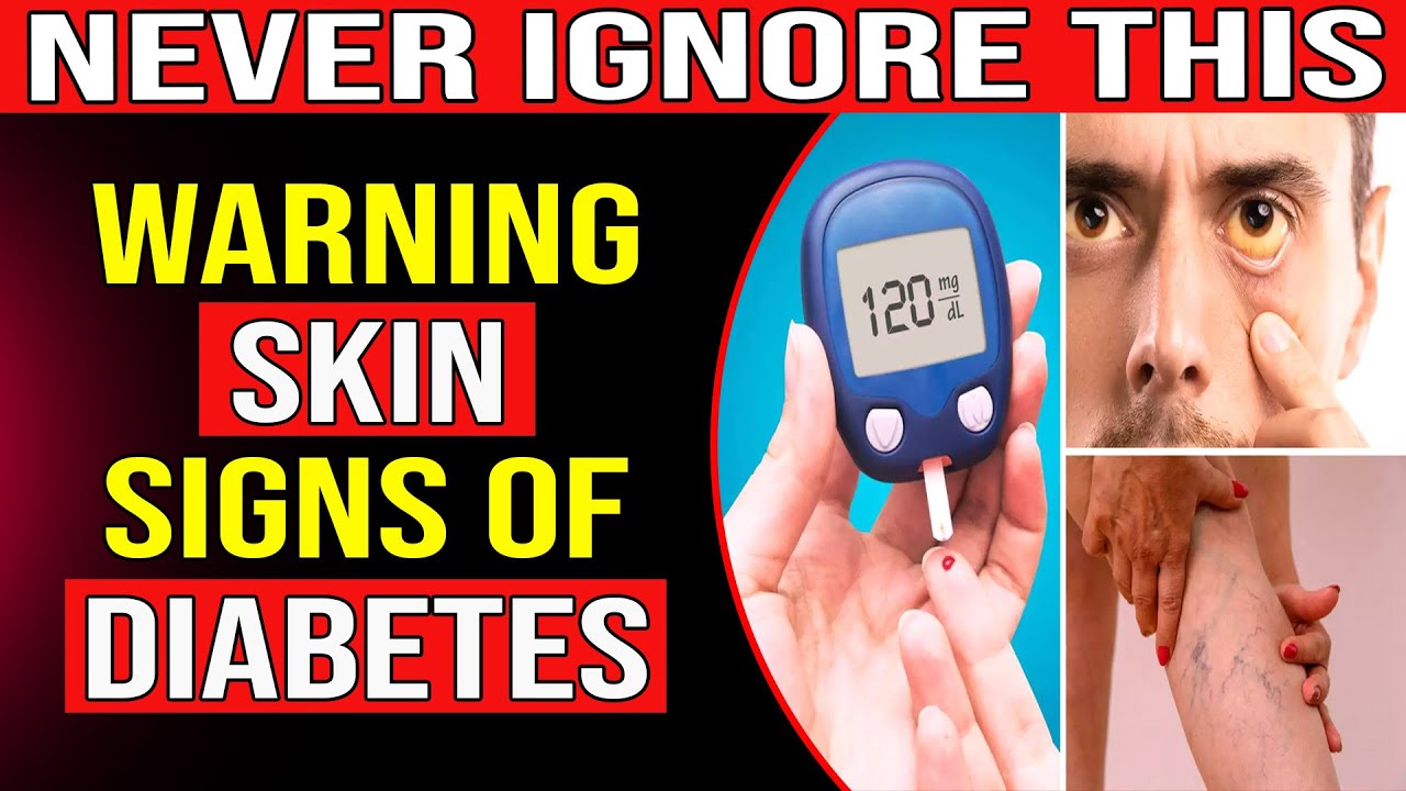 ARE You Aware Of These 11 Common Signs of Diabetes on The SKIN DAMAGE ...