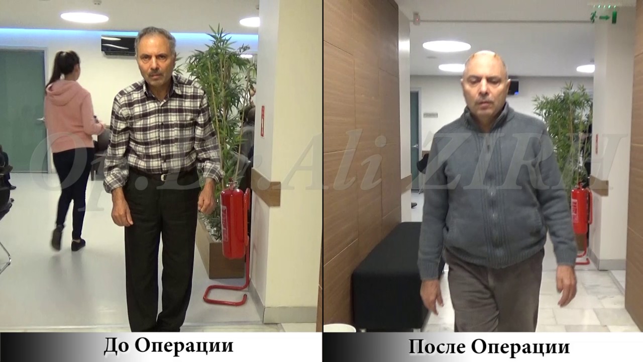 Ismail EROL / До и После Операции - YouTube