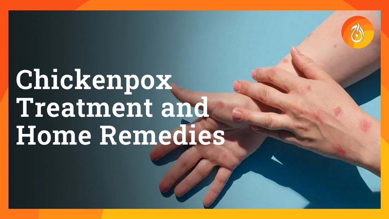 Chickenpox Treatment and Home Remedies on Aaj Food - YouTube