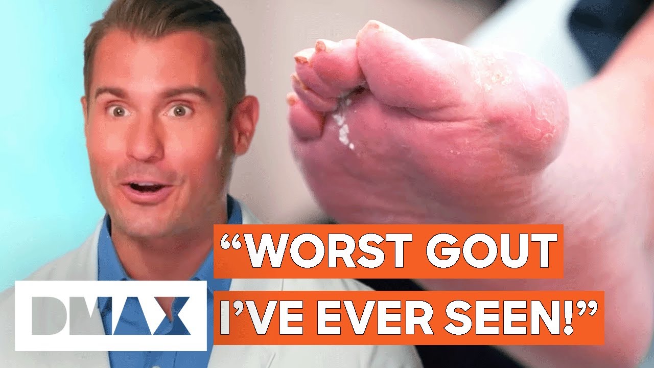 "The Most Severe Case Of Gout I've Ever Seen!" Doctor Is Left ...