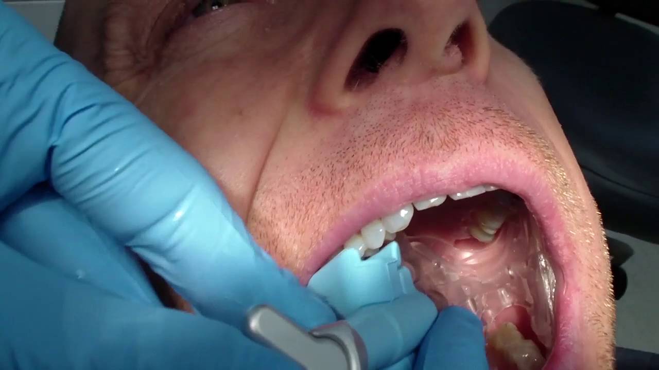 EZ DAM - The Better Dryfield Isolation System - YouTube