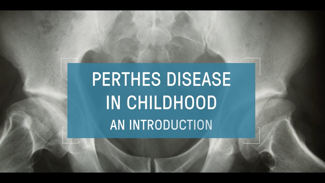 Perthes Disease in Childhood - An Introduction - YouTube