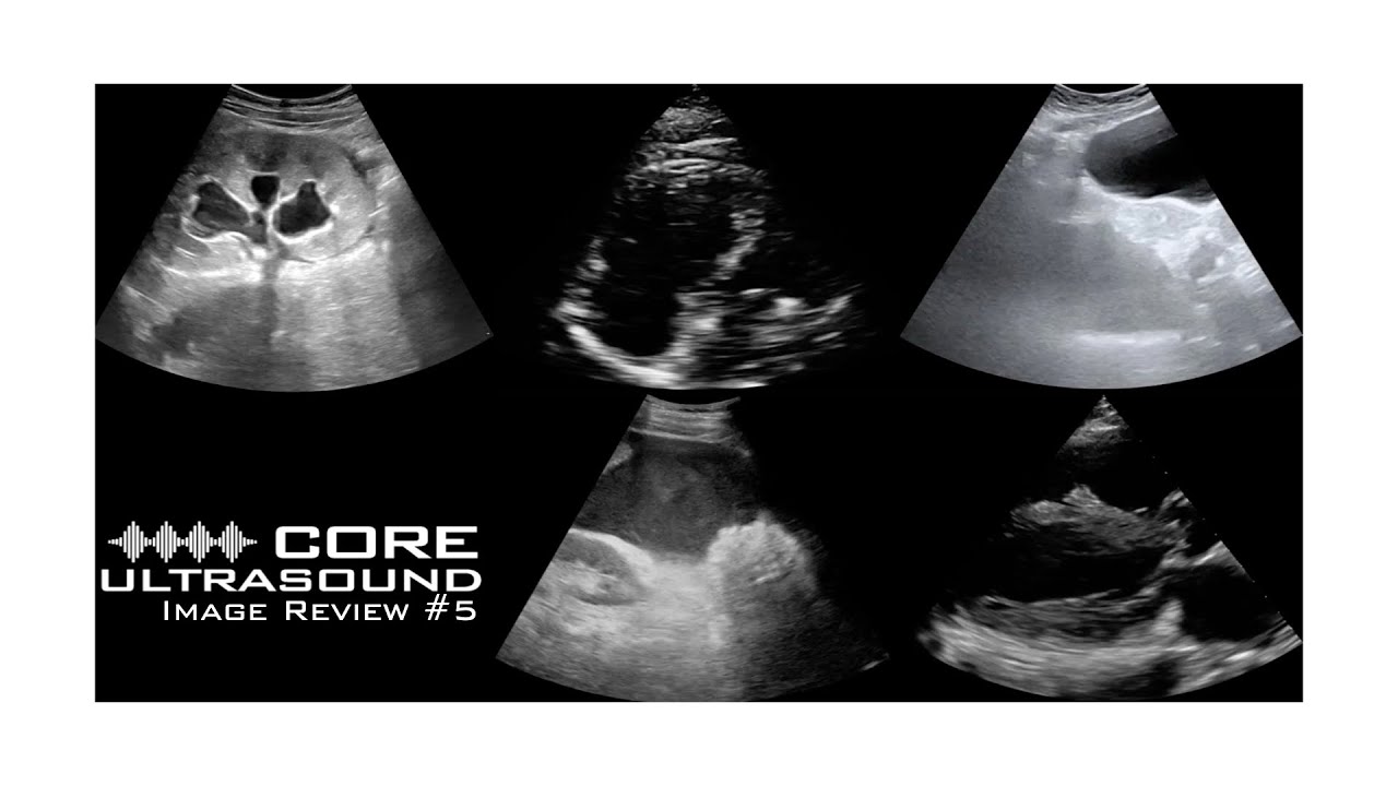 Core Ultrasound Image Review, Episode 5 - YouTube
