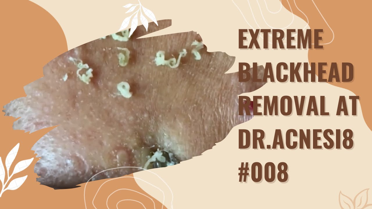 Extreme Blackhead Removal At Dr.Acnesi8 #008 - YouTube
