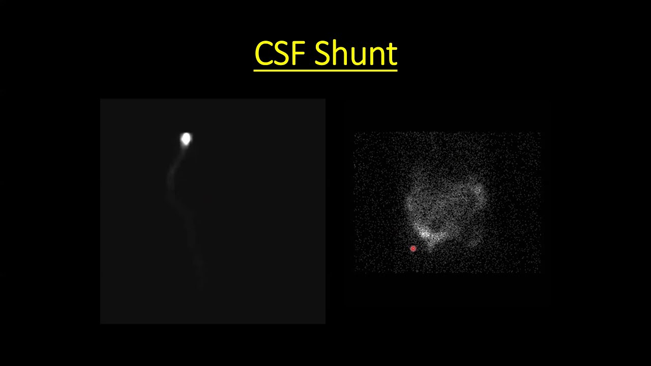 Brain Imaging in Nuclear Medicine - YouTube