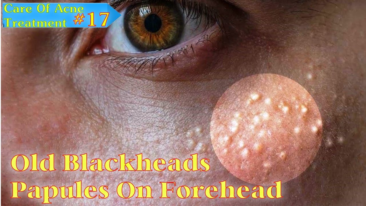 Old Blackheads Papules On Forehead | Care Of Acne Treatment (#17) - YouTube