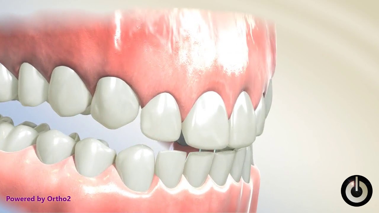 Curve of Spee Correction, Upper TAD | Dental Braces | Temecula Valley ...