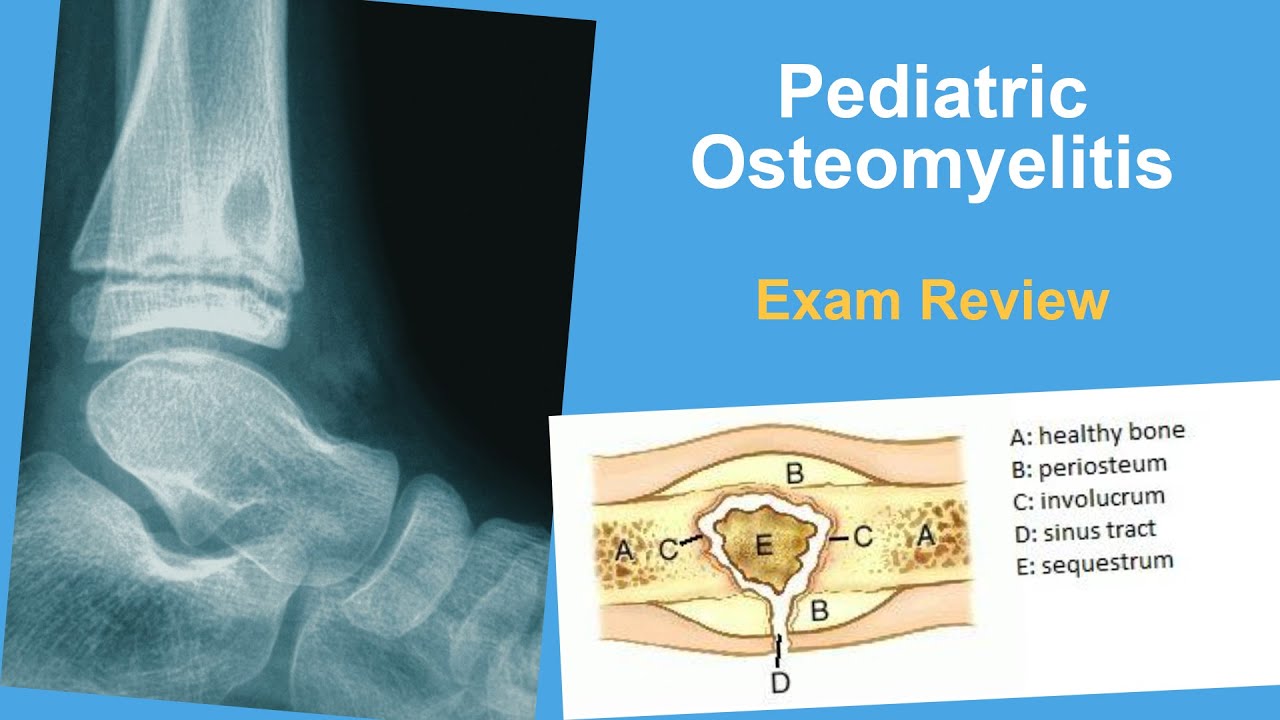 Pediatric Osteomyelitis Exam Review - Lindsay Andras, MD - YouTube