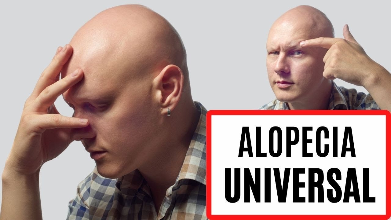 Alopecia Universal | Causas y posibles TRATAMIENTOS ⬅ - YouTube