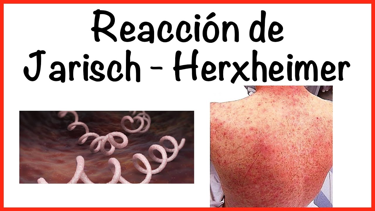 Reacción de Jarisch - Herxheimer - YouTube