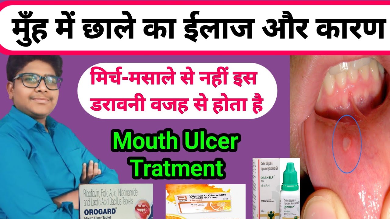 मुँह के छाले कारण व ईलाज | Mouth ulcer Treatment | Muh ke chale kaise ...