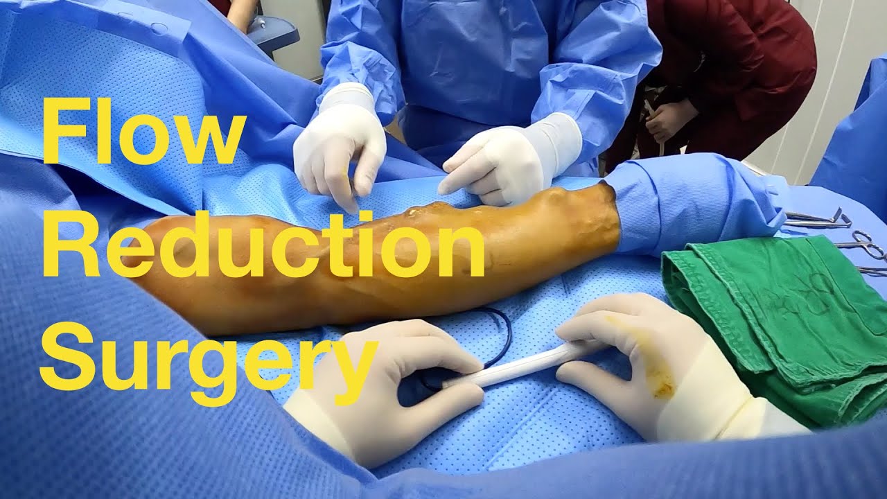 AVF, Flow reduction surgery, Graft interposition (동정맥루 혈류 감량 수술, 인조혈관 ...