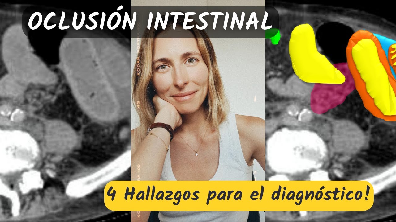 Oclusión intestinal 😳 ¡4 Hallazgos tomográficos para hacer el ...