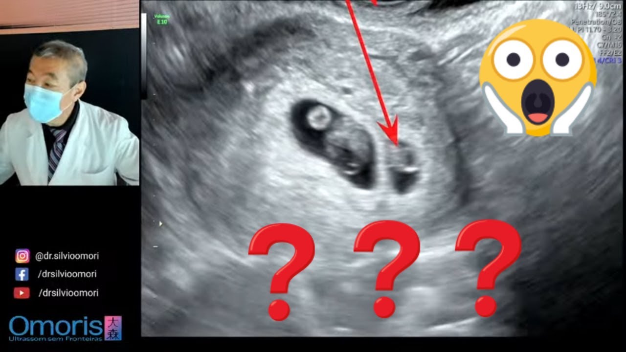Mãe de gêmeos se surpreende em ultrassom!! Segunda gravidez - Gestação ...