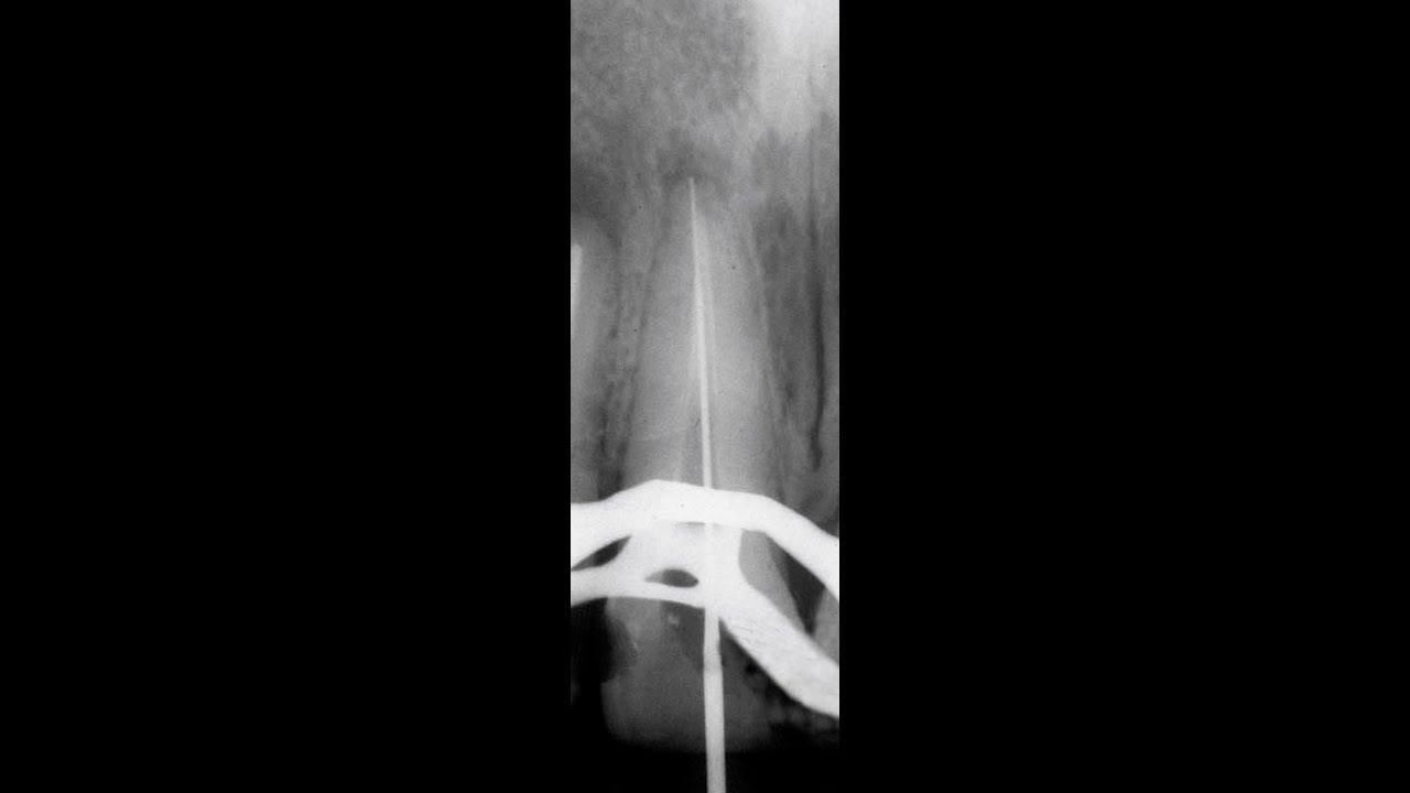 O limite apical de trabalho não é mais como aprendemos - YouTube