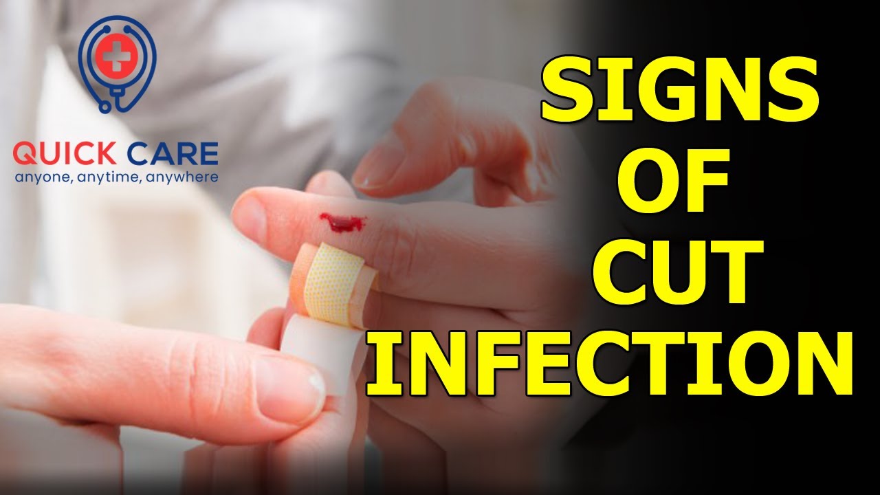 SIGNS OF INFECTION (If a cut is infected) | Quick Care - YouTube